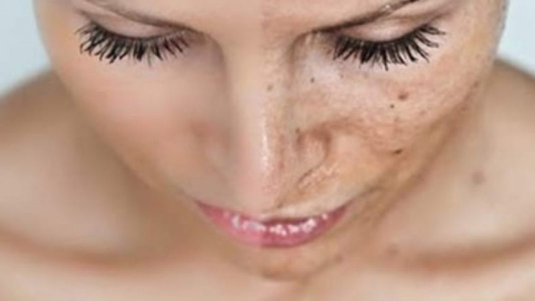 Macchie cutanee, come farle sparire? Gli esperti fanno chiarezza